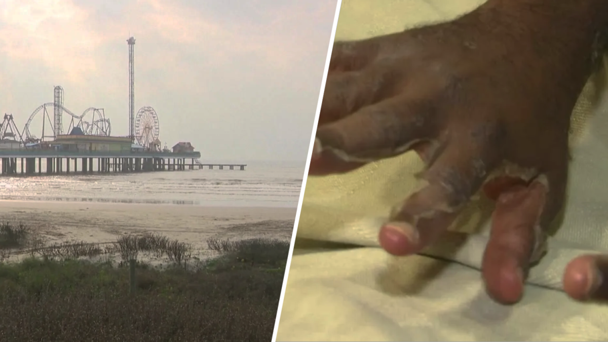 Galveston en alerta por incremento de casos de bacteria “come carne ...